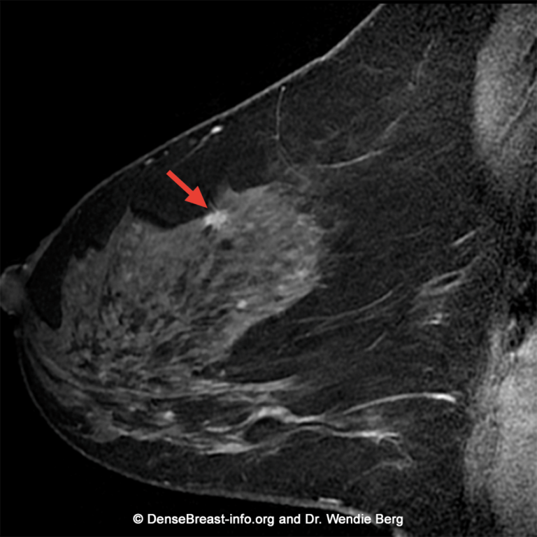 Breast MRI | DenseBreast-info, Inc.