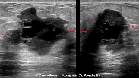 Mammography, 3D Mammography (Tomosynthesis) | DenseBreast-info, Inc.